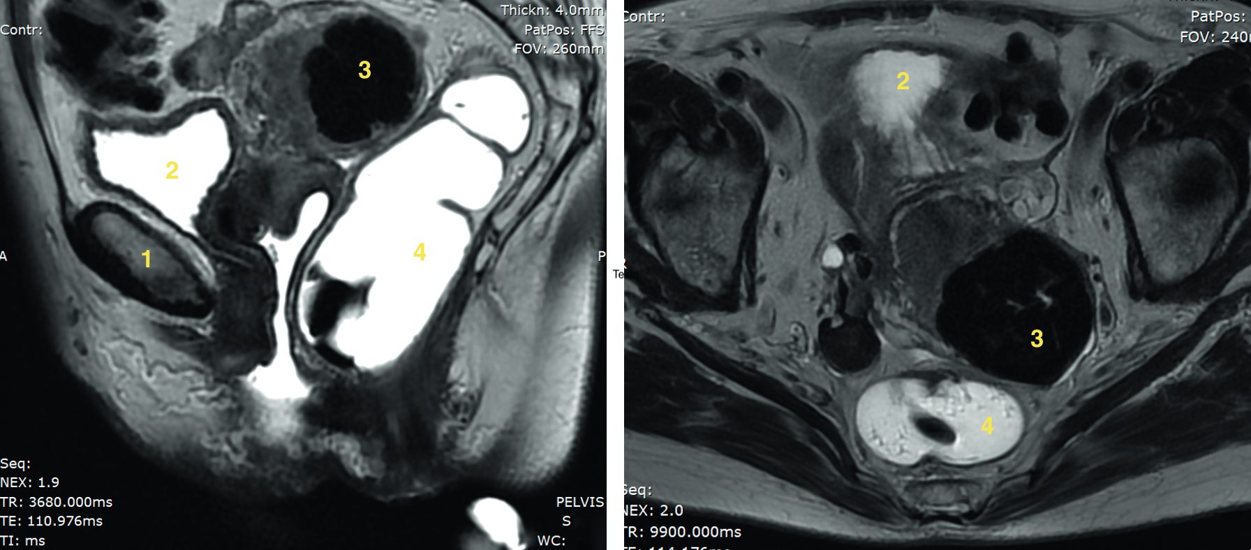 Chapitre 20 – Tuméfaction pelvienne chez la femme – Livre rouge CERF