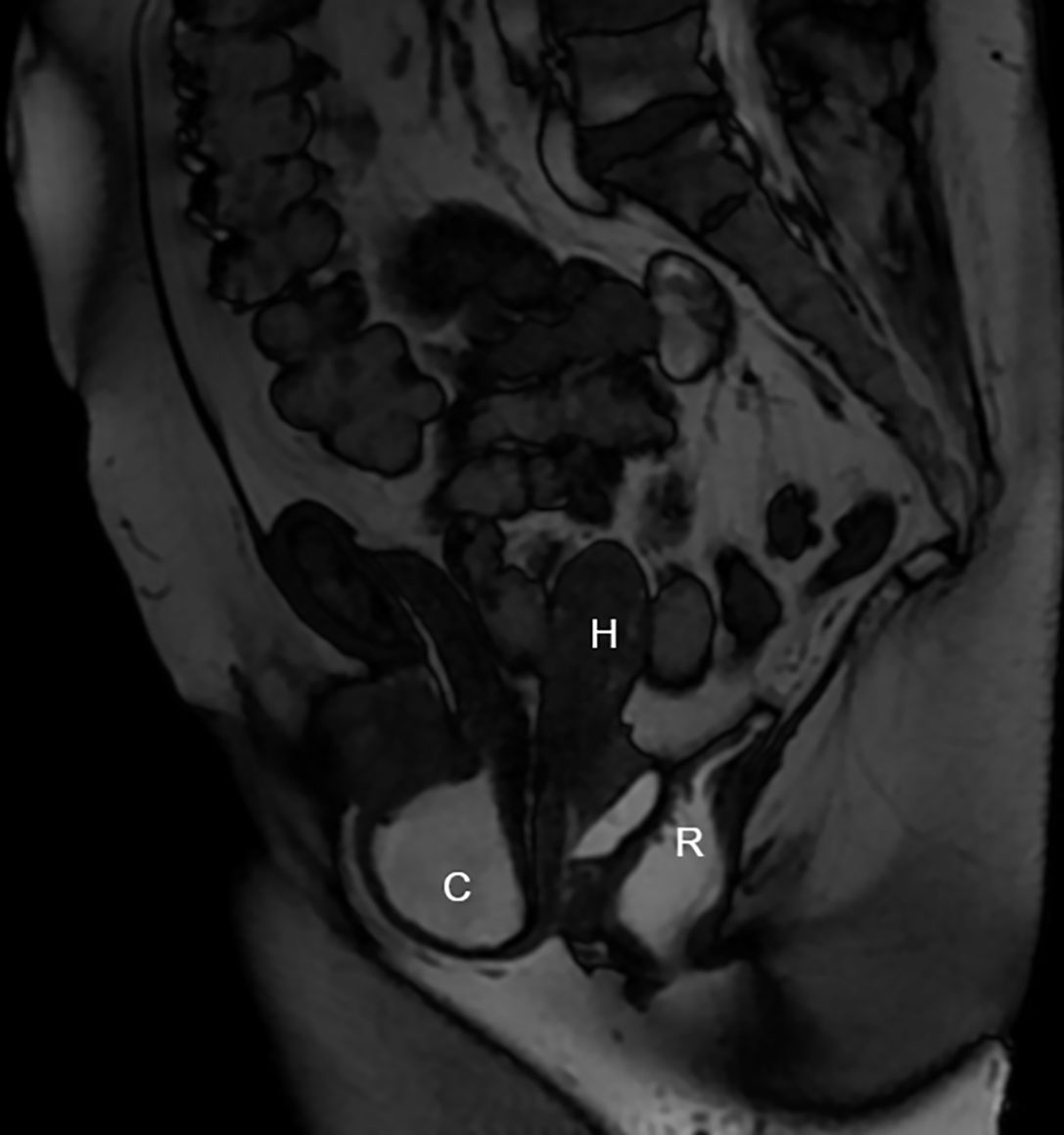 Chapitre 20 – Tuméfaction pelvienne chez la femme – Livre rouge CERF