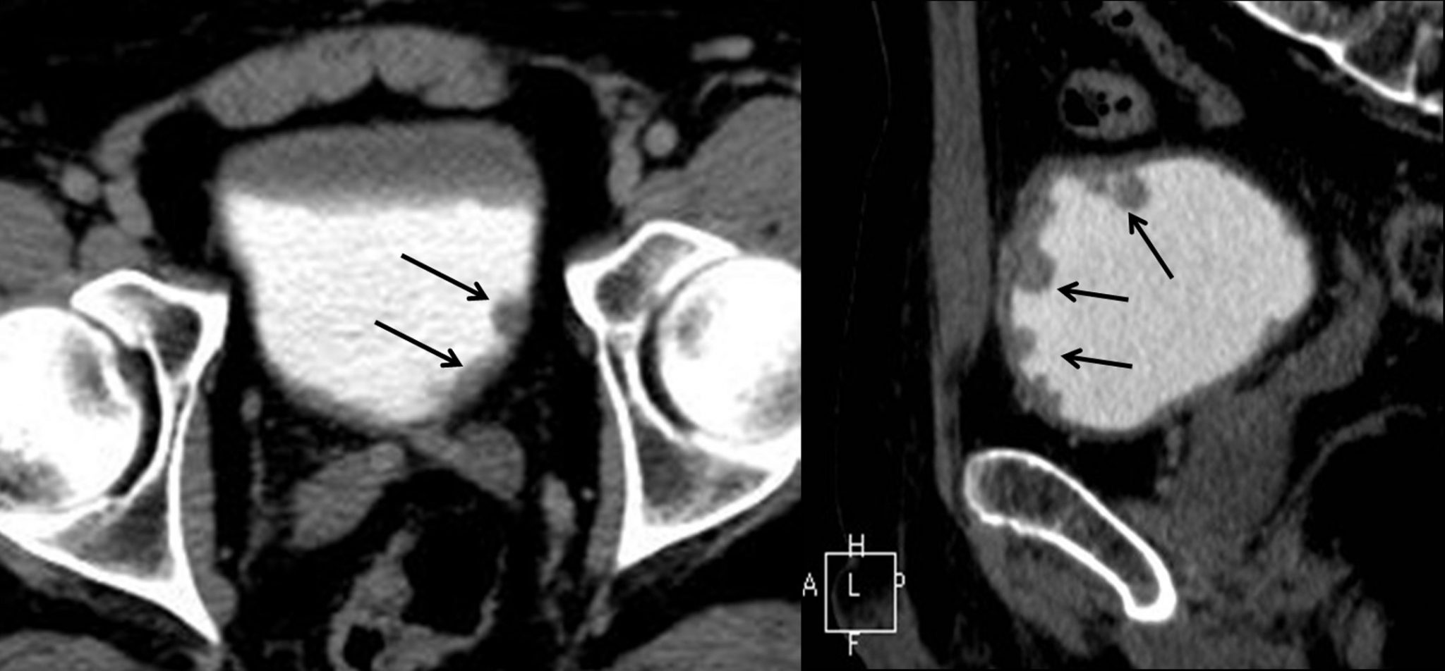 Chapitre 24 -Hématurie de l’adulte – Livre rouge CERF
