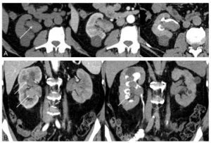 Chapitre 24 -Hématurie de l’adulte – Livre rouge CERF