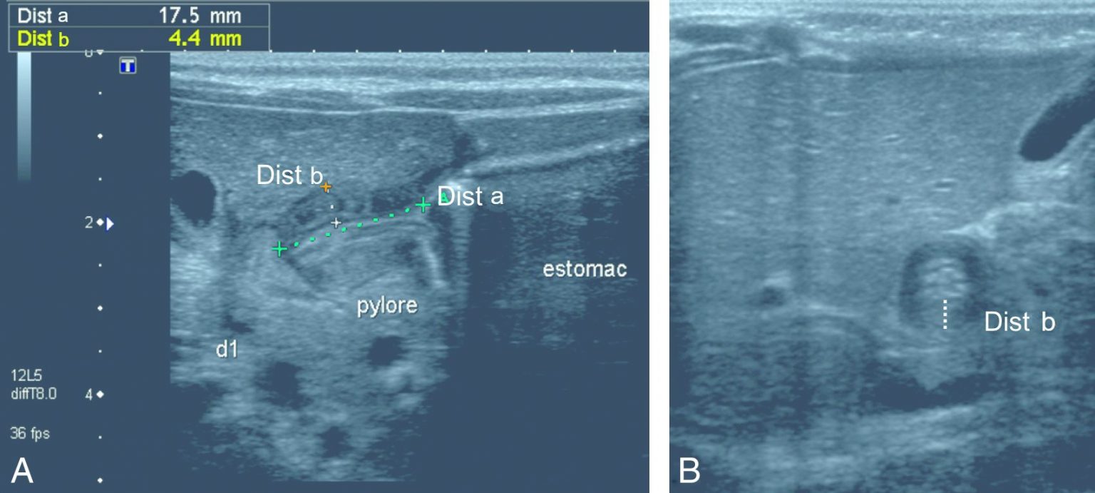 Chapitre 104 – Sténose hypertrophique du pylore – Livre rouge CERF
